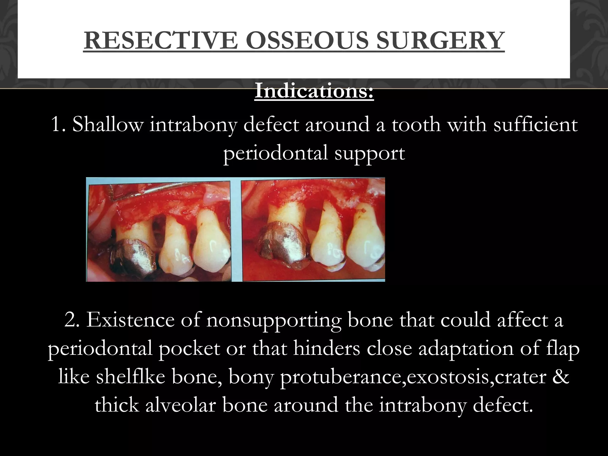 Osseous surgery | PPT