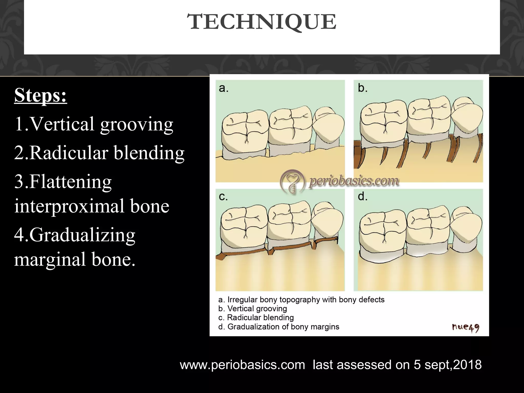 Osseous surgery | PPT