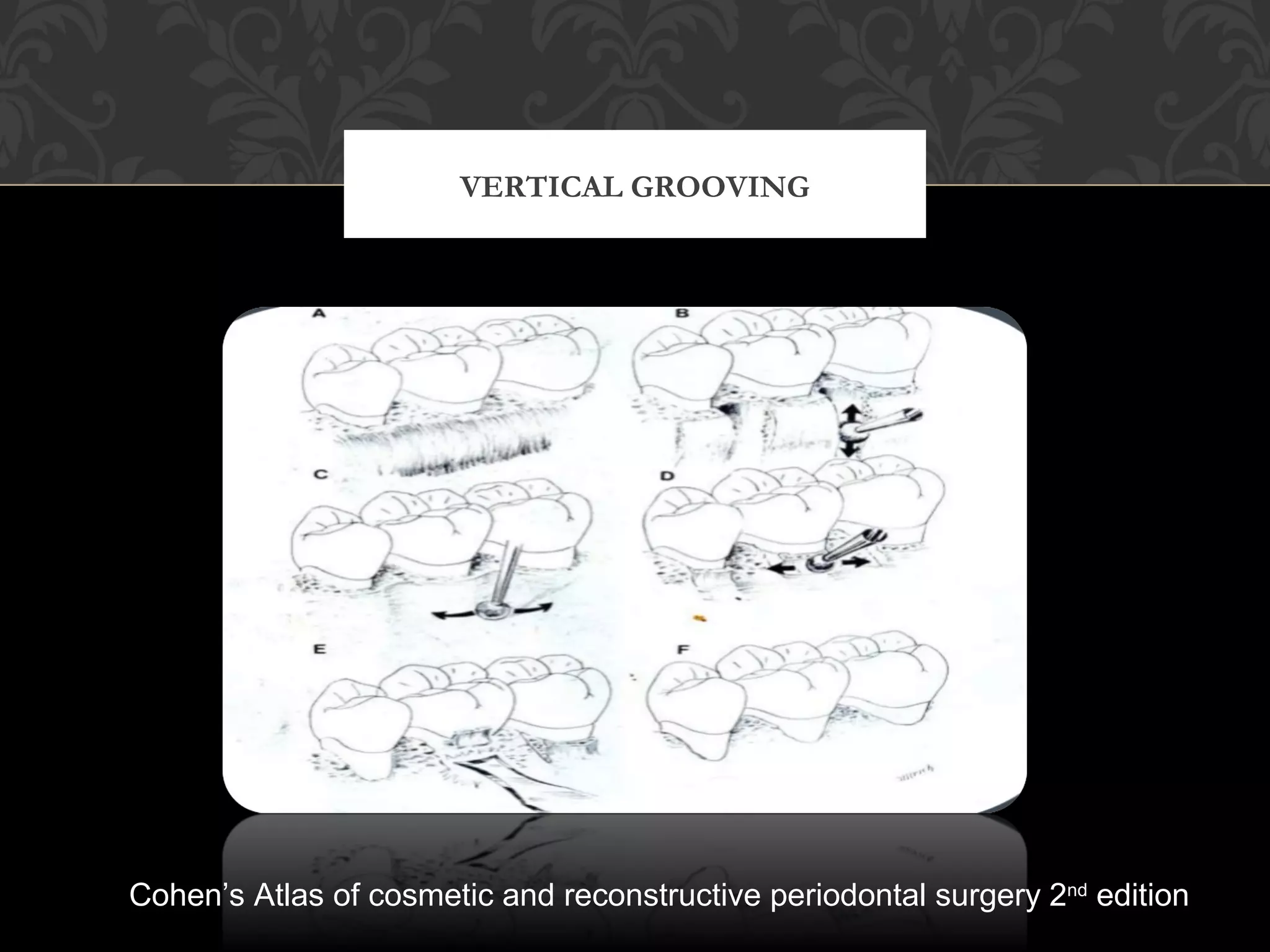 Osseous surgery | PPT