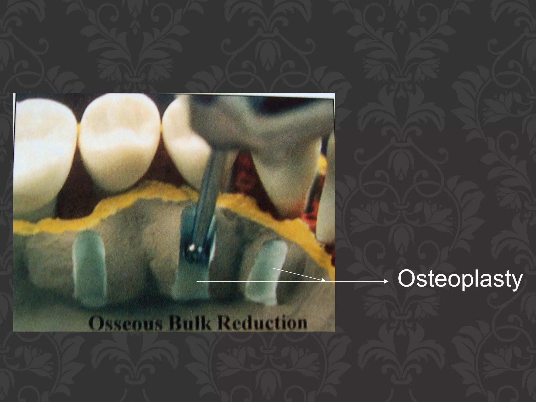 Osseous surgery | PPT