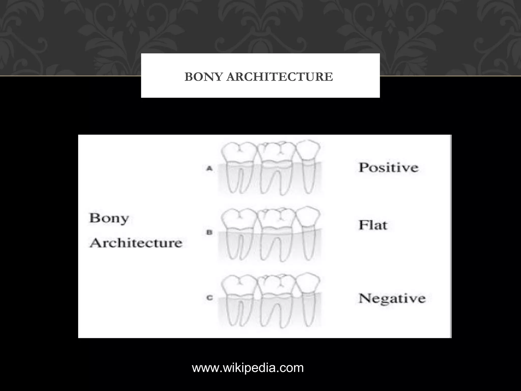 Osseous surgery | PPT