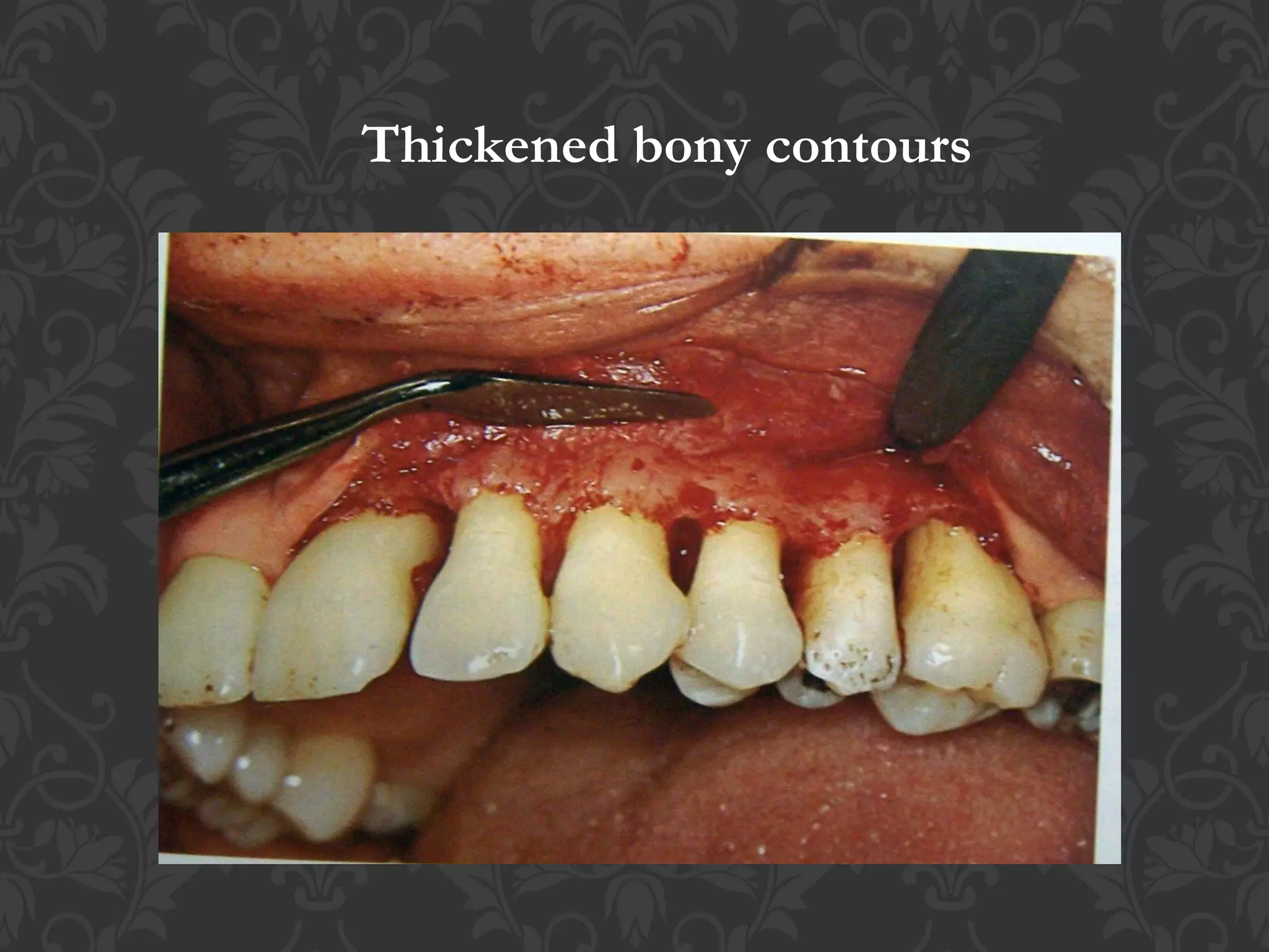 Osseous surgery | PPT