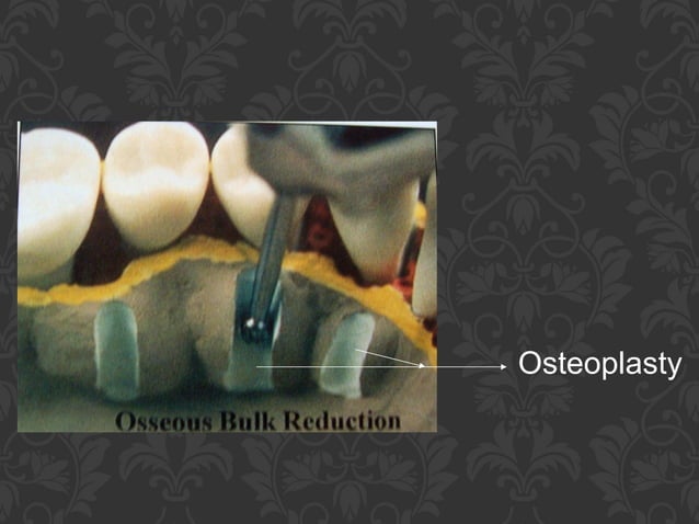 Osseous surgery | PPT | Dental Health | Diseases and Conditions