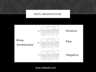 Osseous surgery | PPT