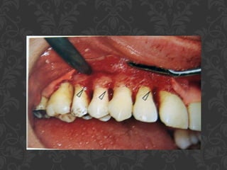 Osseous surgery | PPT