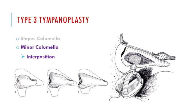 Ossicular reconstruction | PPT
