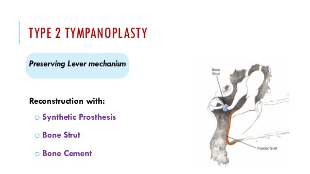 Ossicular reconstruction