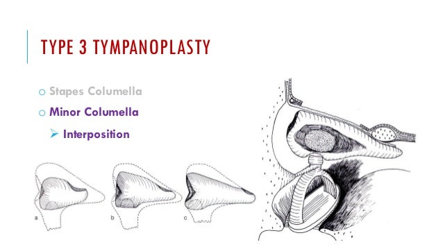 Ossicular reconstruction