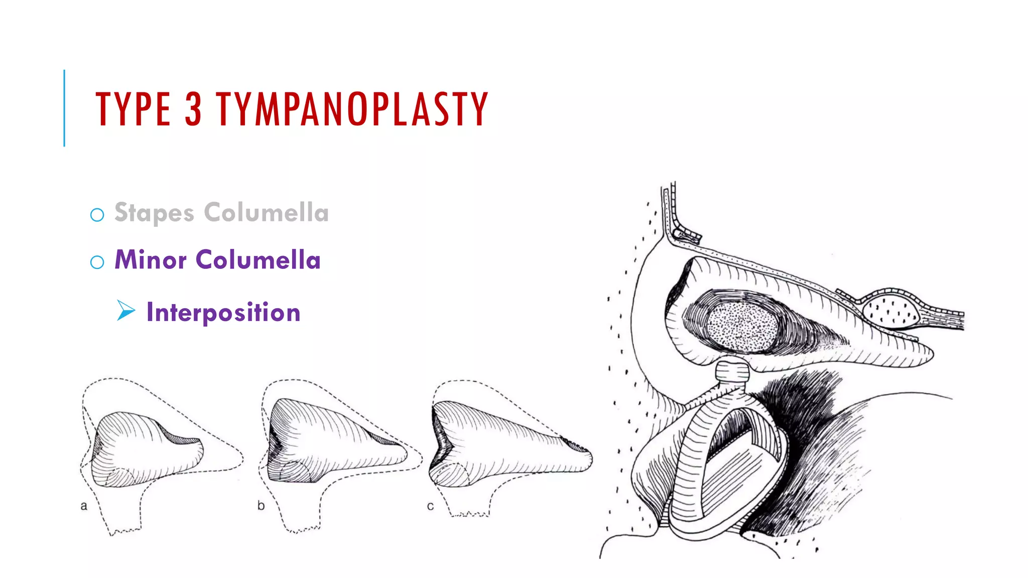 Tympanoplasty( Ossicular Chain Reconstruction) | PDF