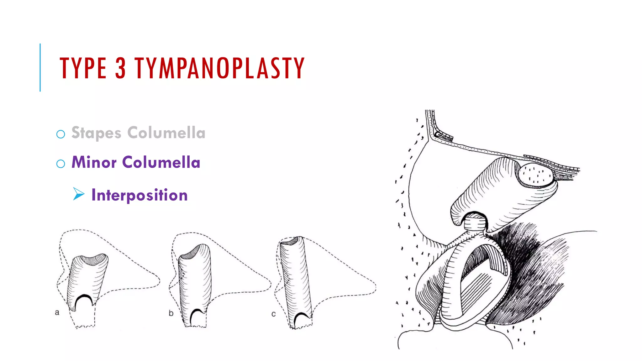Tympanoplasty( Ossicular Chain Reconstruction) | PDF