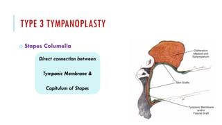 Tympanoplasty( Ossicular Chain Reconstruction) | PDF