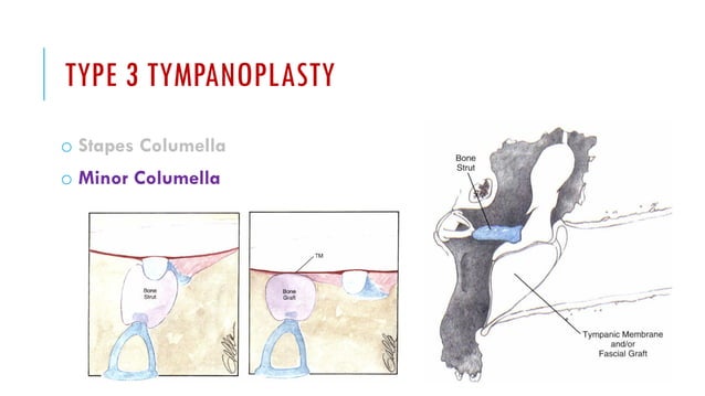 Tympanoplasty( Ossicular Chain Reconstruction) | PDF