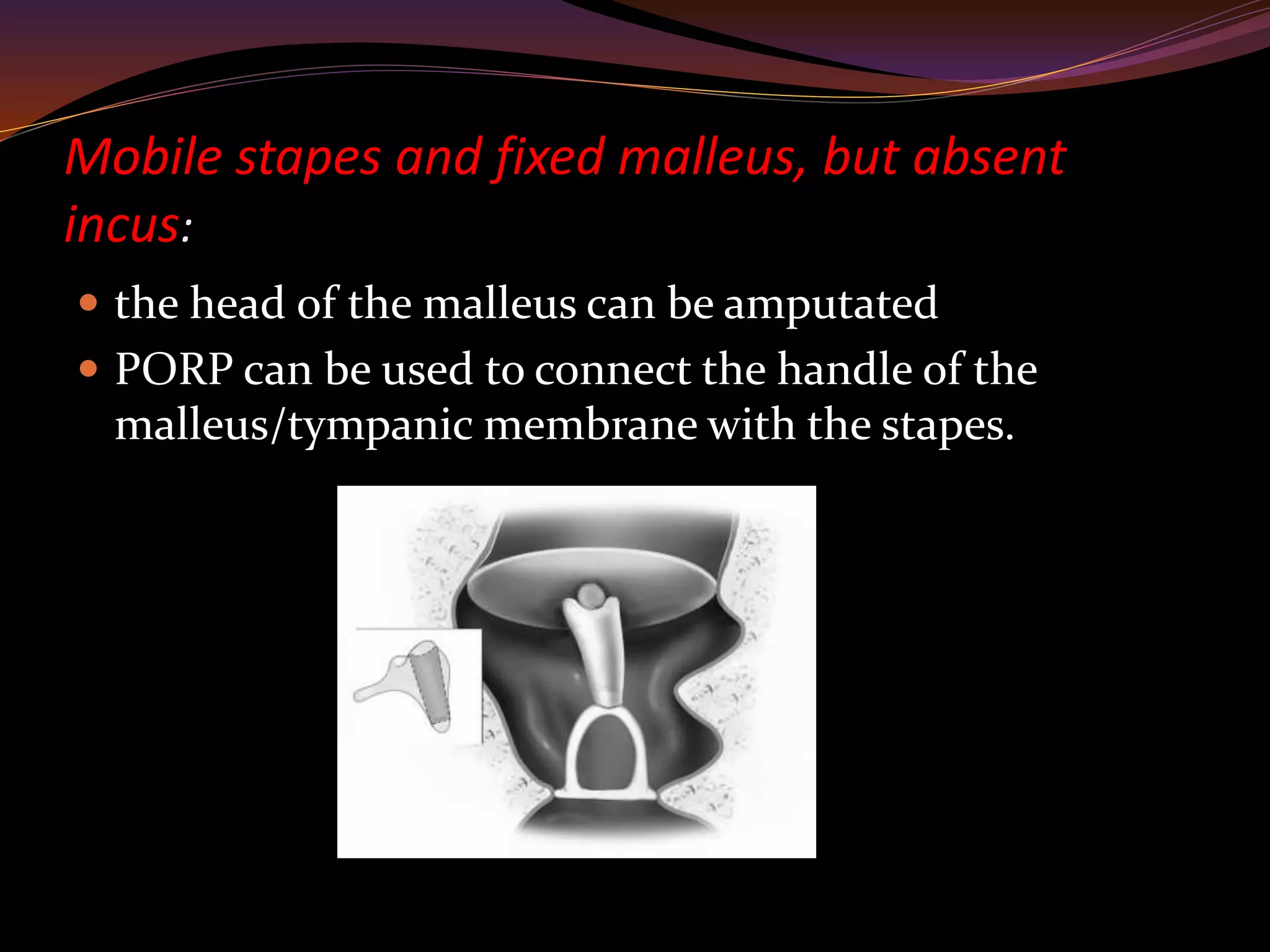 Ossiculoplasty | PPTX
