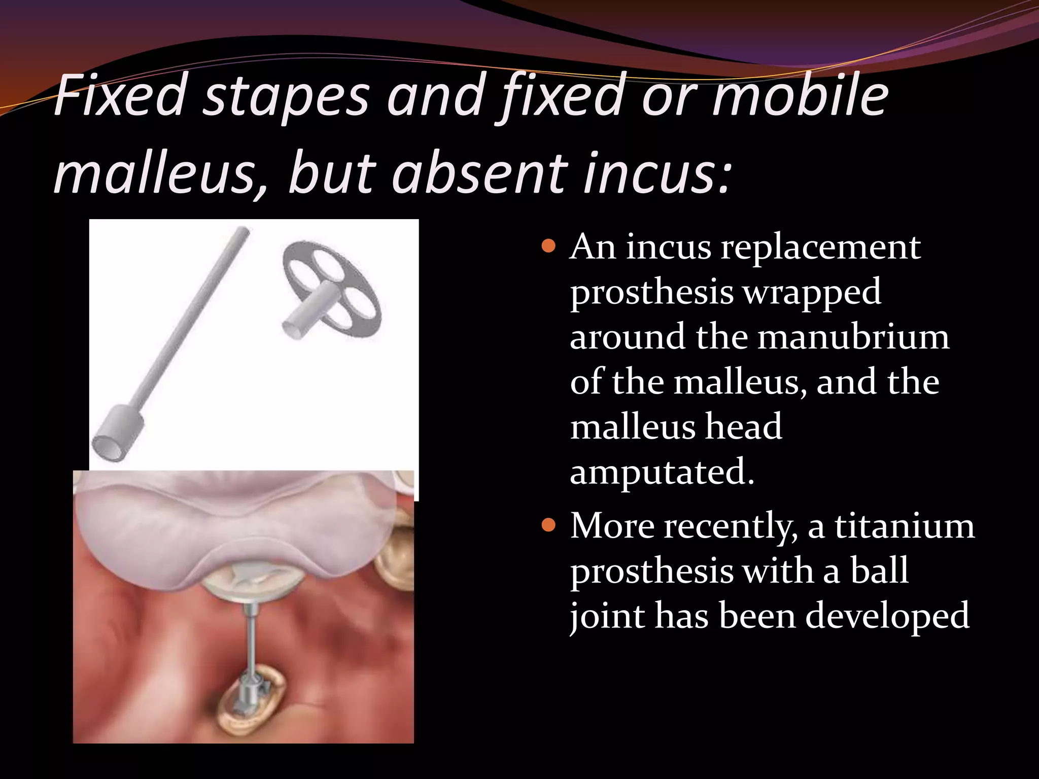 Ossiculoplasty | PPTX