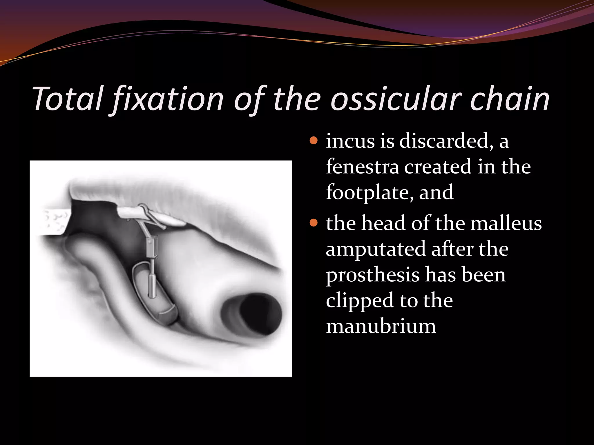 Ossiculoplasty | PPTX