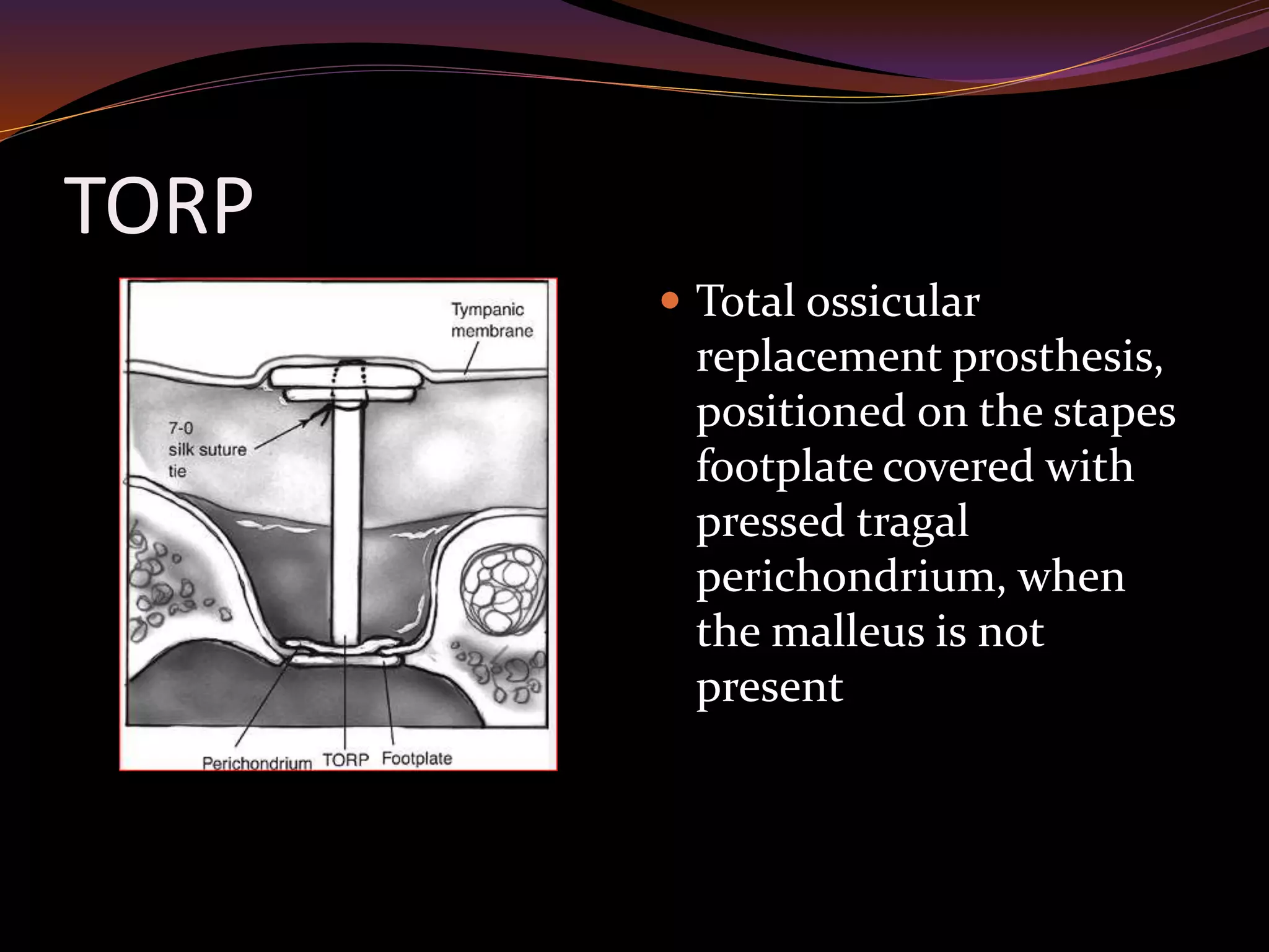 Ossiculoplasty | PPTX