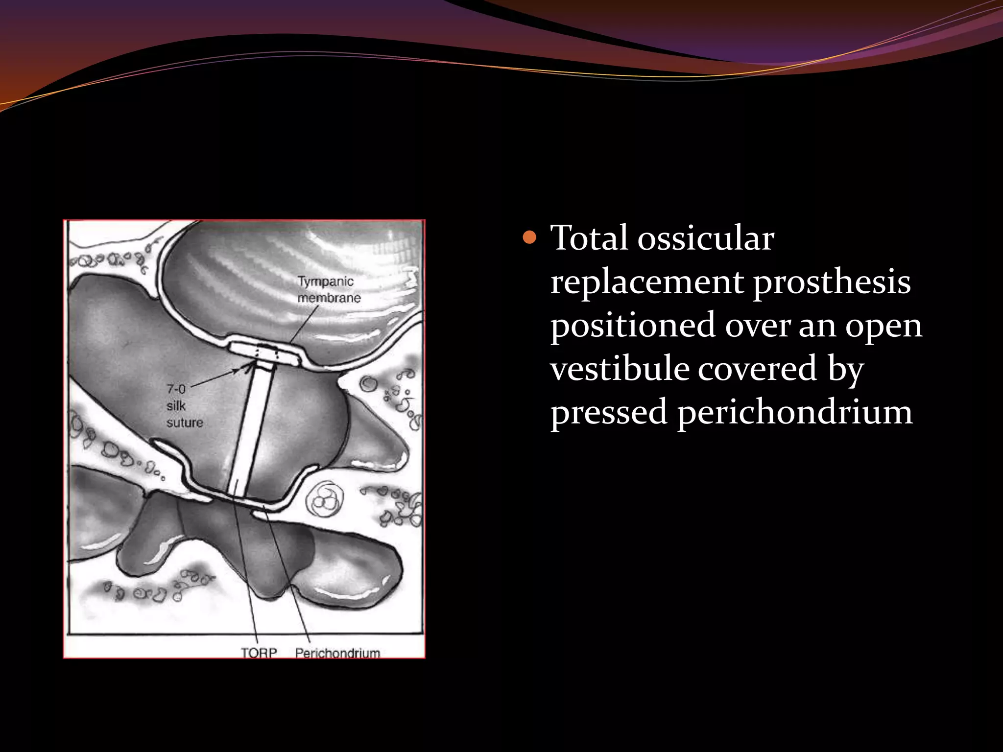 Ossiculoplasty | PPTX