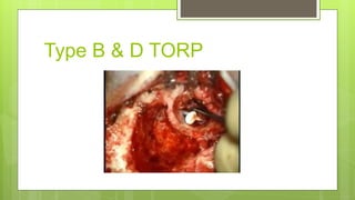 Ossiculoplasty | PPTX