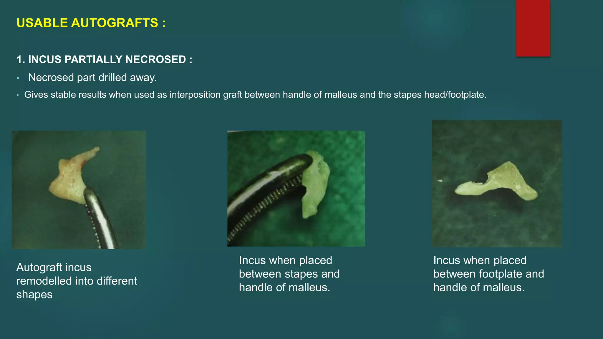 Ossiculoplasty | PPTX