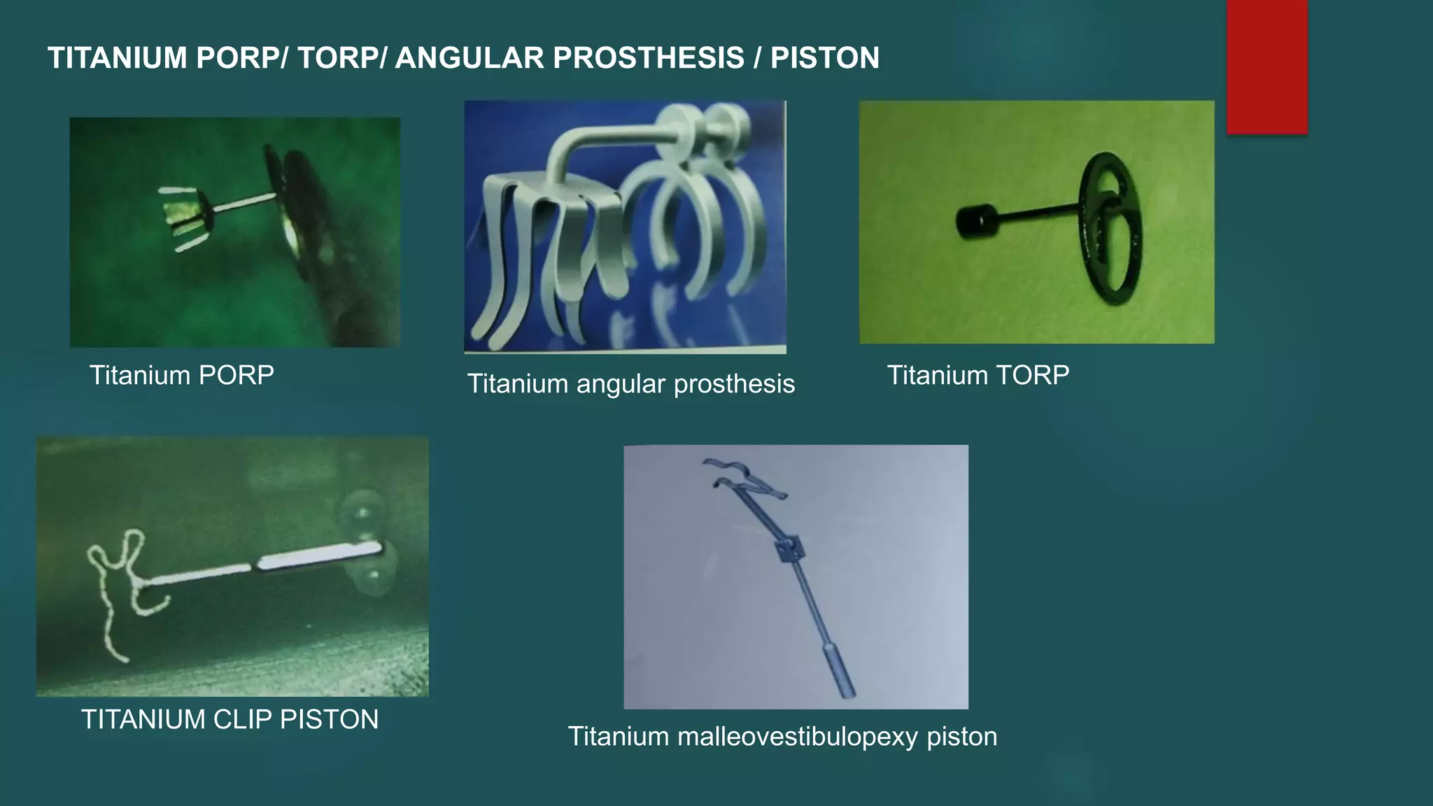 Ossiculoplasty | PPTX