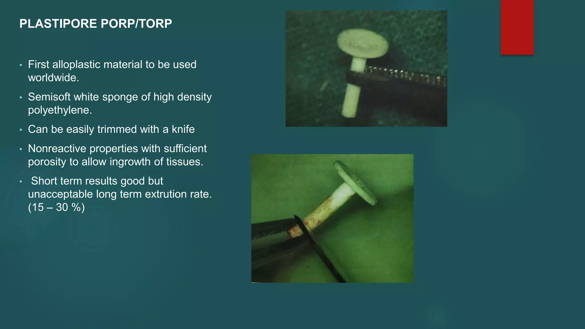 Ossiculoplasty | PPTX