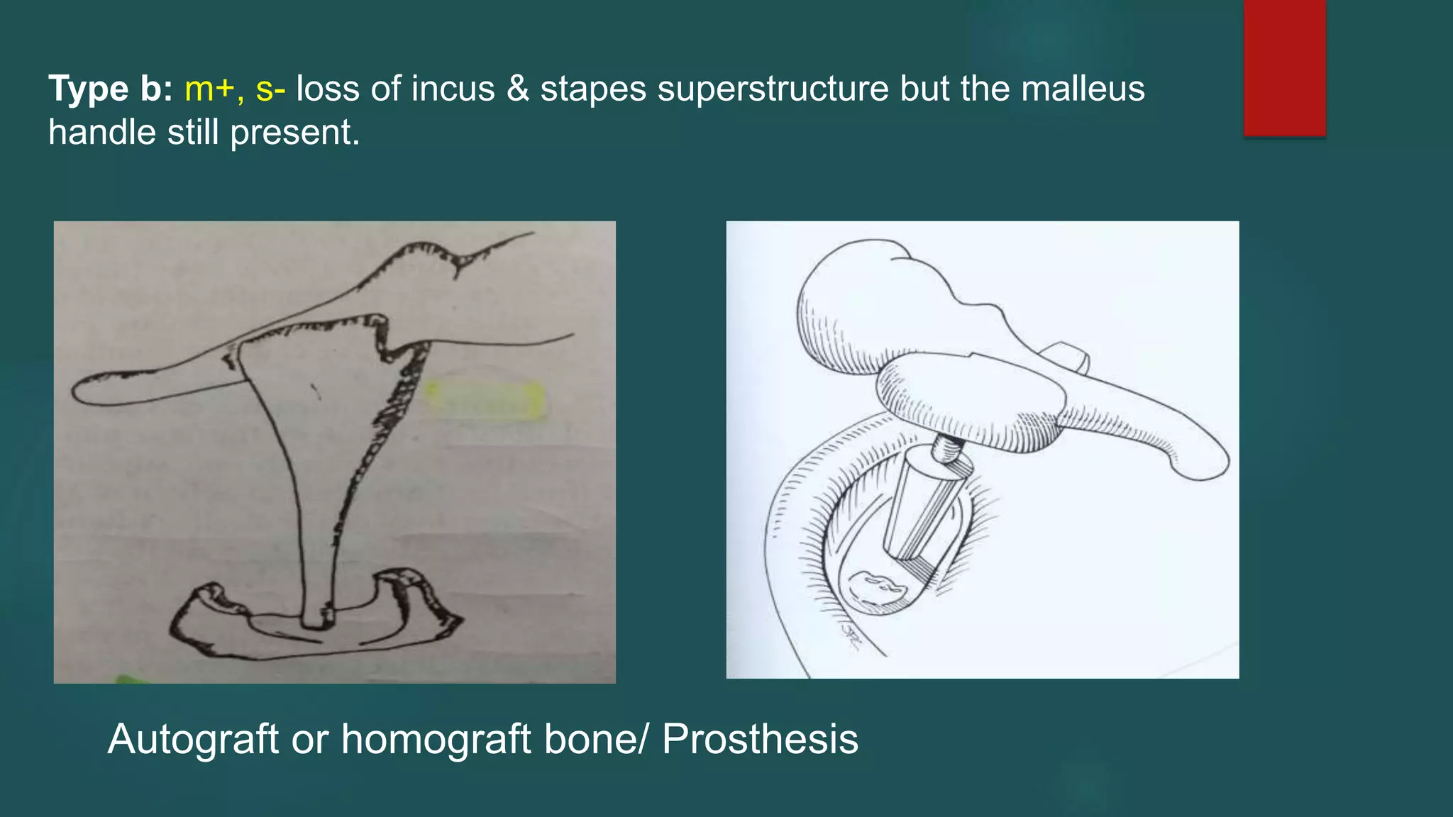 Ossiculoplasty | PPTX