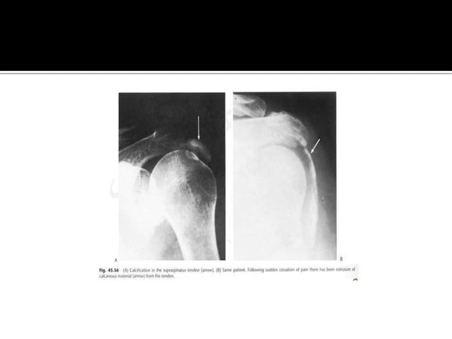 Ossification & calcification | PPTX | Bone and Joint Conditions ...