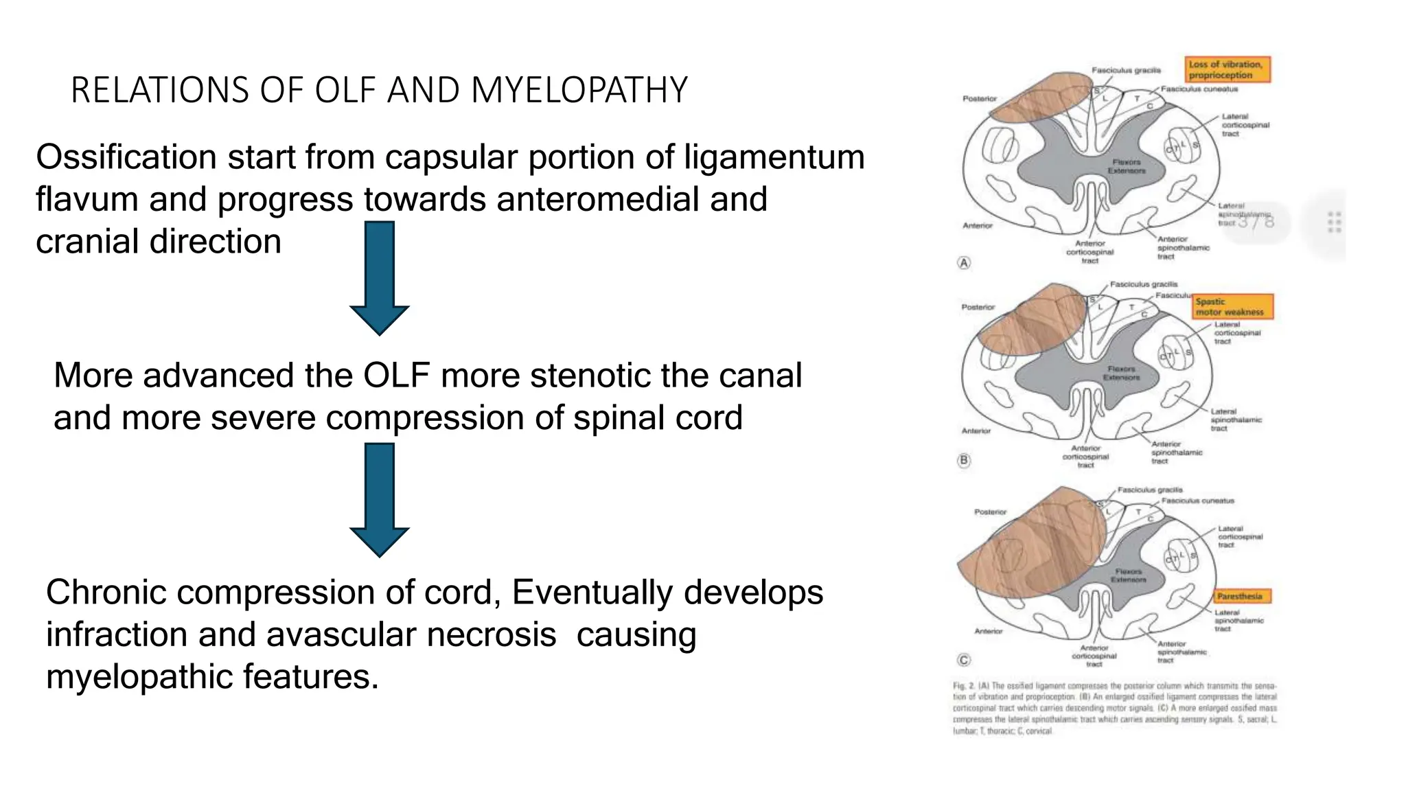 ossification of yellow ligament and management | PPT