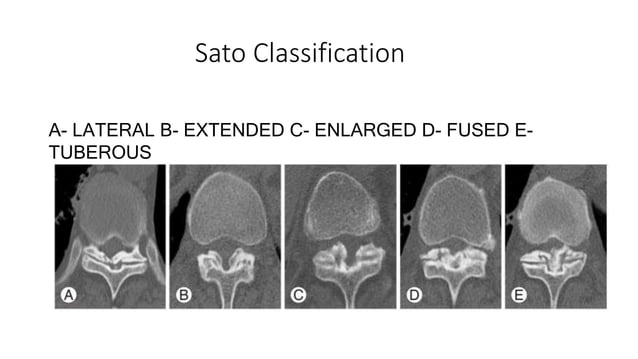 ossification of yellow ligament and management | PPT