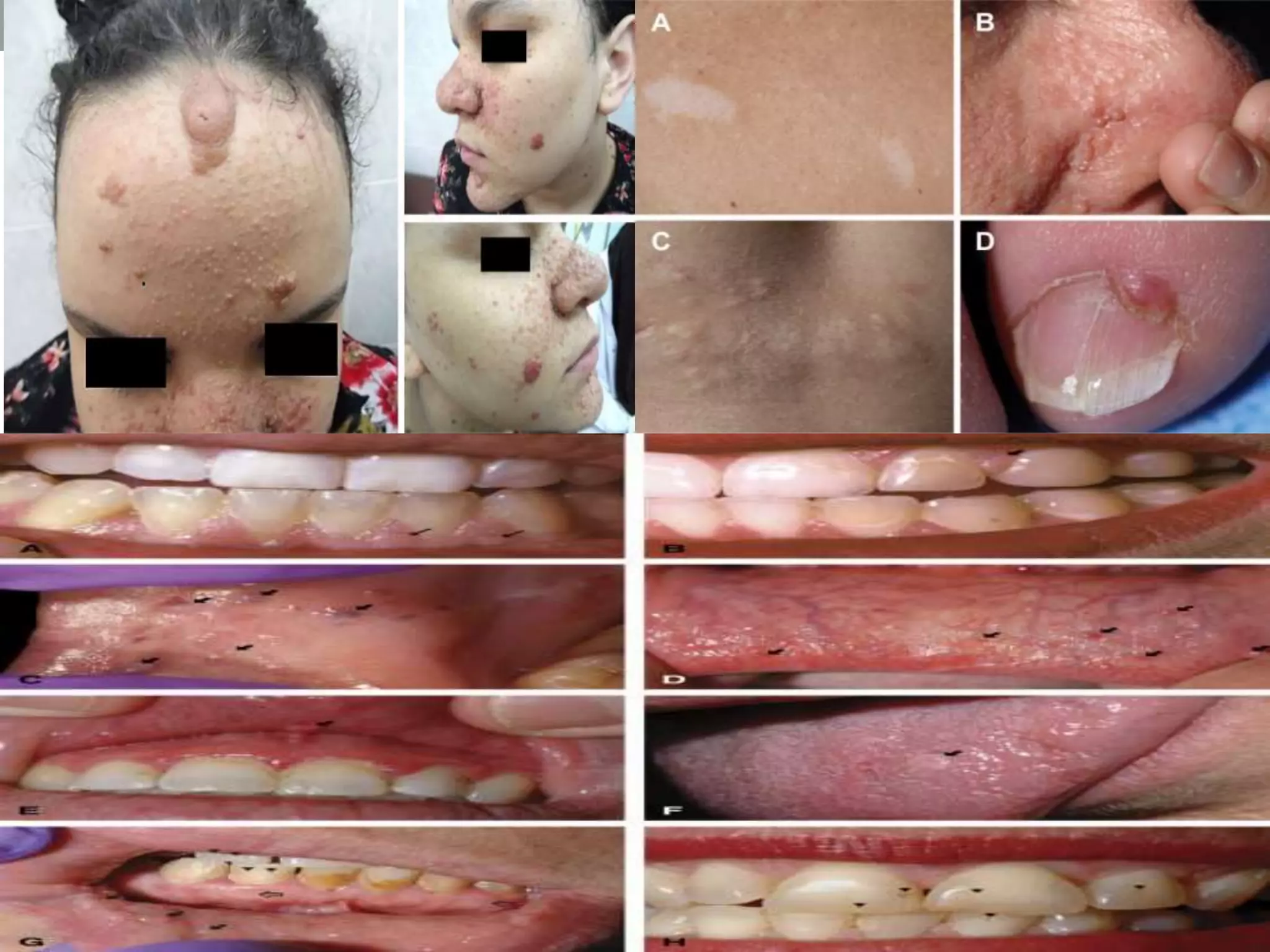 Ossifying fibroma and cementifying fibroma | PPTX