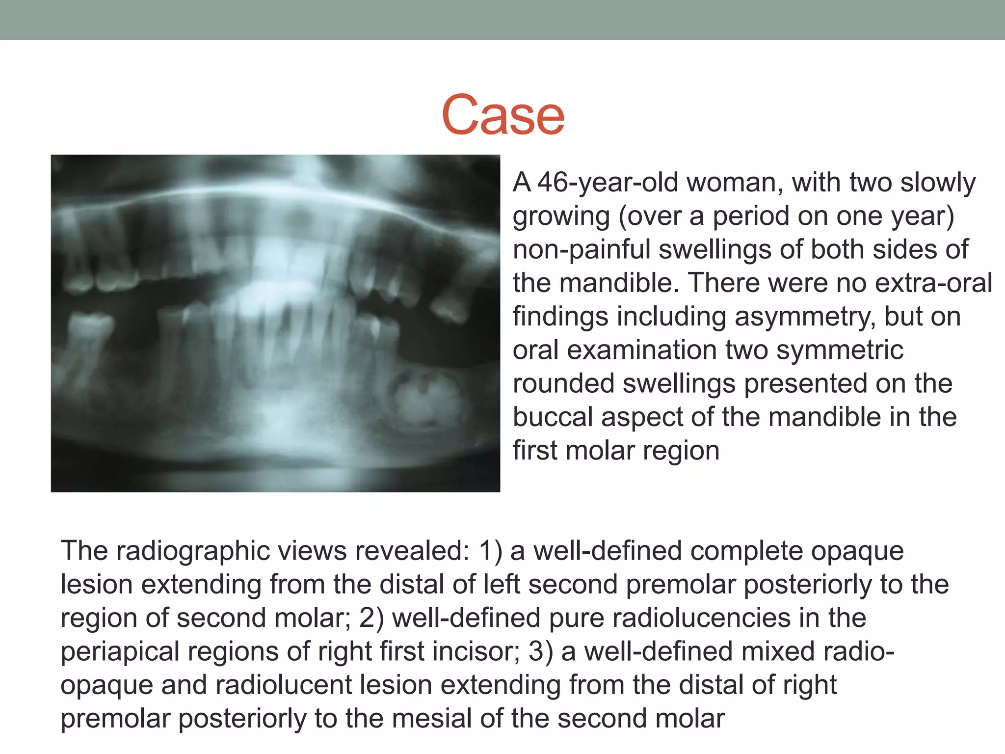 Ossifying fibroma and cementifying fibroma | PPTX