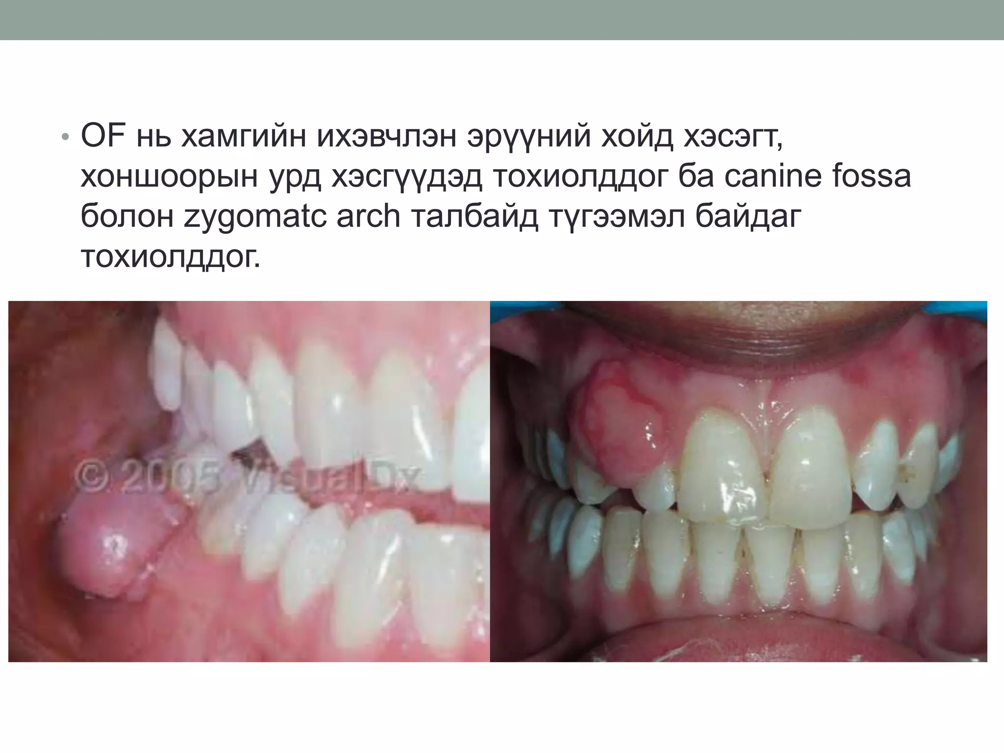 Ossifying fibroma and cementifying fibroma | PPTX