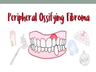 Ossifying fibroma and cementifying fibroma | PPTX