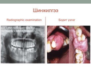 Ossifying fibroma and cementifying fibroma | PPTX