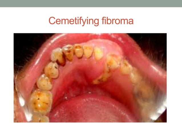 Ossifying fibroma and cementifying fibroma | PPTX