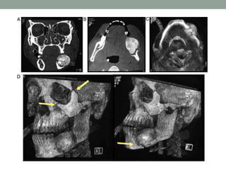 Ossifying fibroma and cementifying fibroma | PPTX
