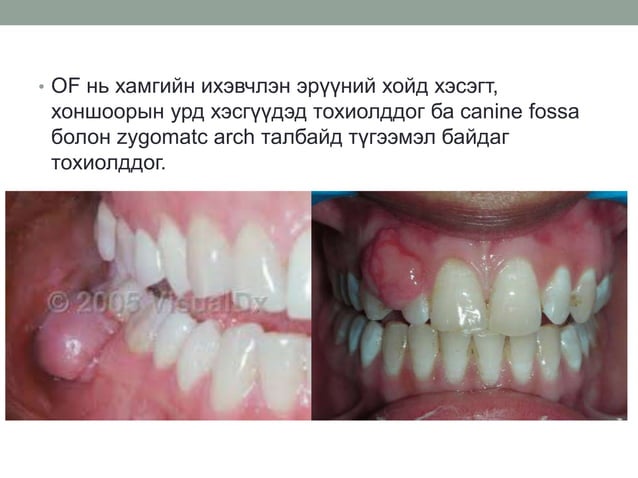 Ossifying fibroma and cementifying fibroma | PPTX