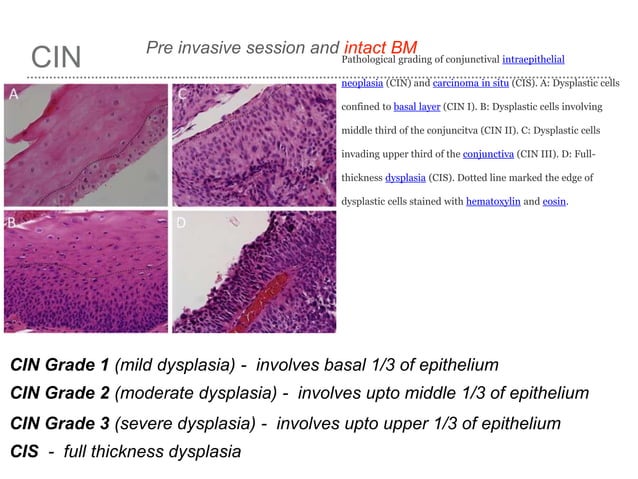 OSSN | PPT | Eye and Vision Conditions | Diseases and Conditions
