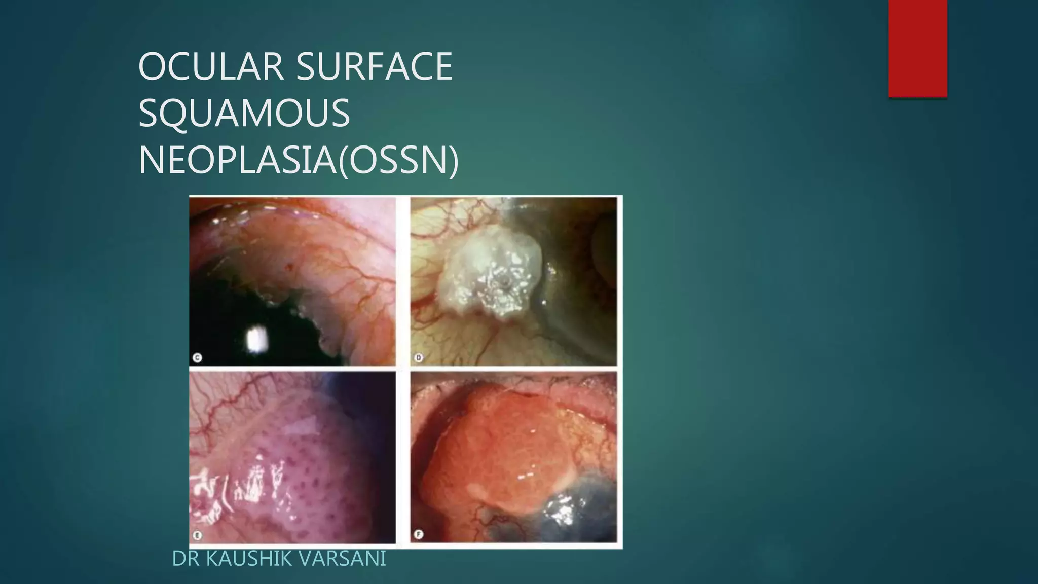 OSSN(ocular surface squamous neoplasia) | PPTX
