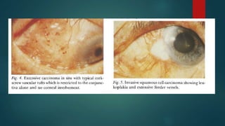 OSSN(ocular surface squamous neoplasia) | PPTX
