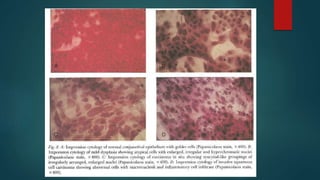 OSSN(ocular surface squamous neoplasia) | PPTX