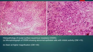 OSSN(ocular surface squamous neoplasia) | PPTX