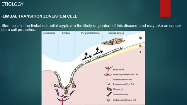 OSSN(ocular surface squamous neoplasia) | PPTX