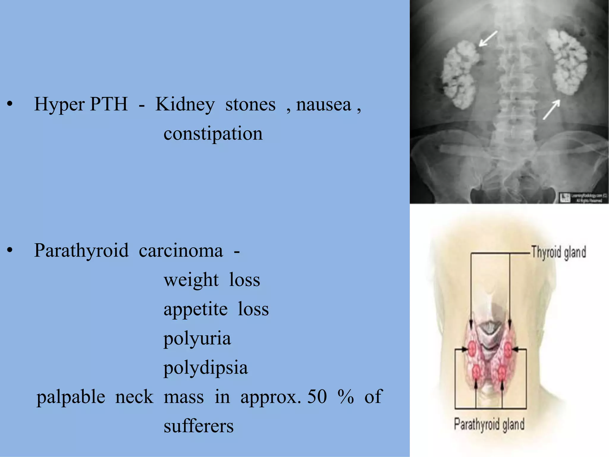 Osteitis fibrosa cystica | PPTX