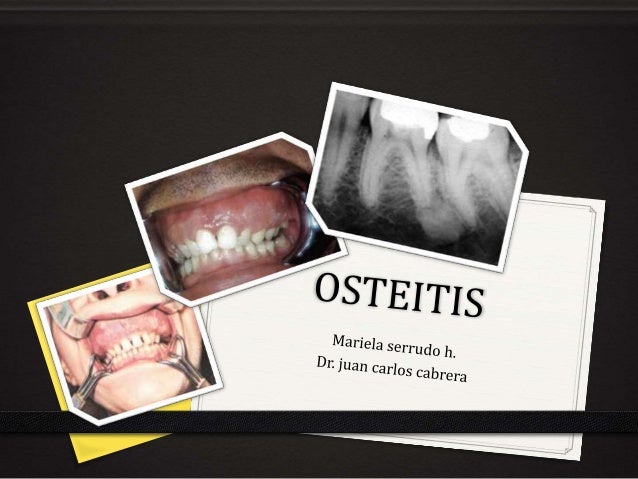 Qué Es Osteítis _ Descubre todo sobre la osteitis: causas, síntomas y ...
