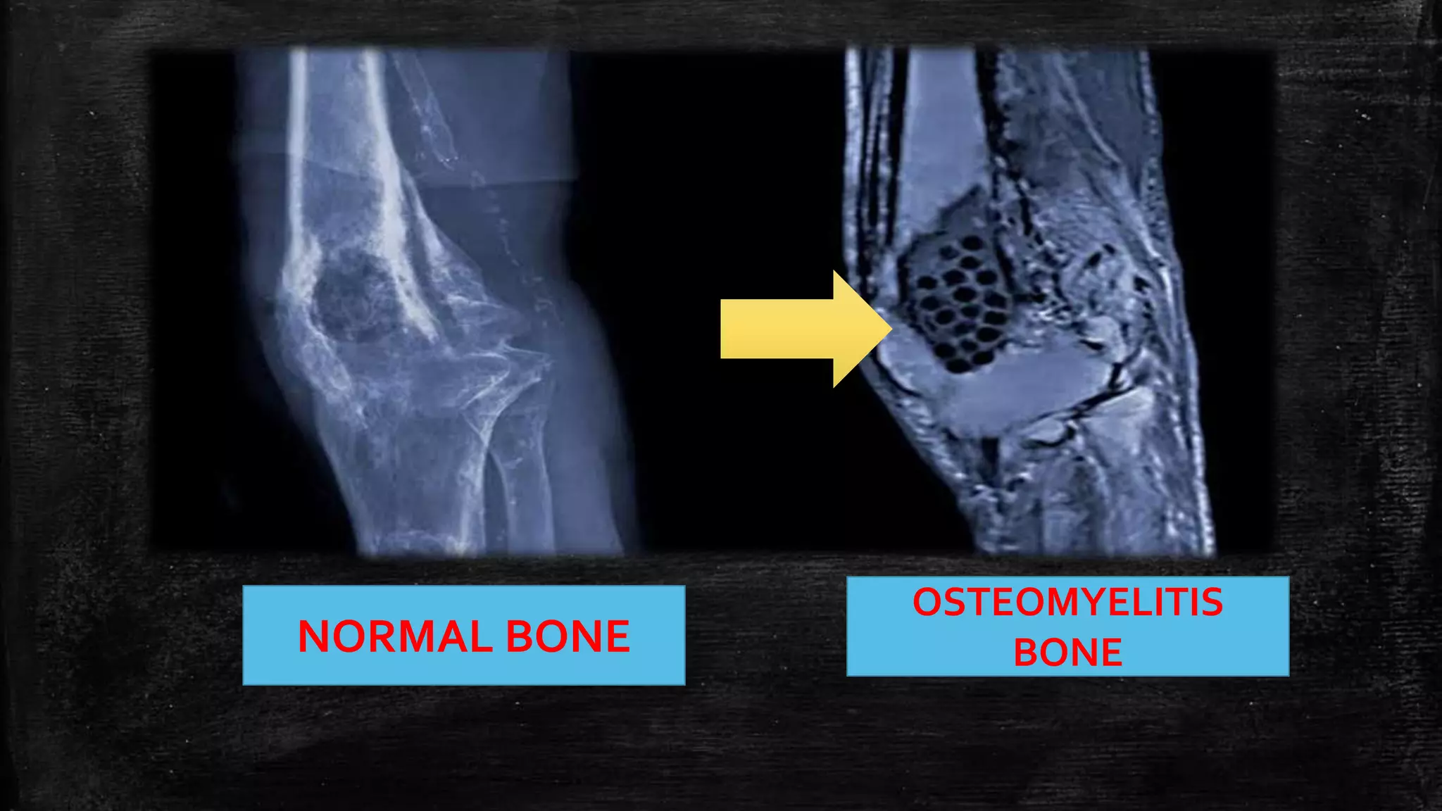 Ostemyelitis | PPT