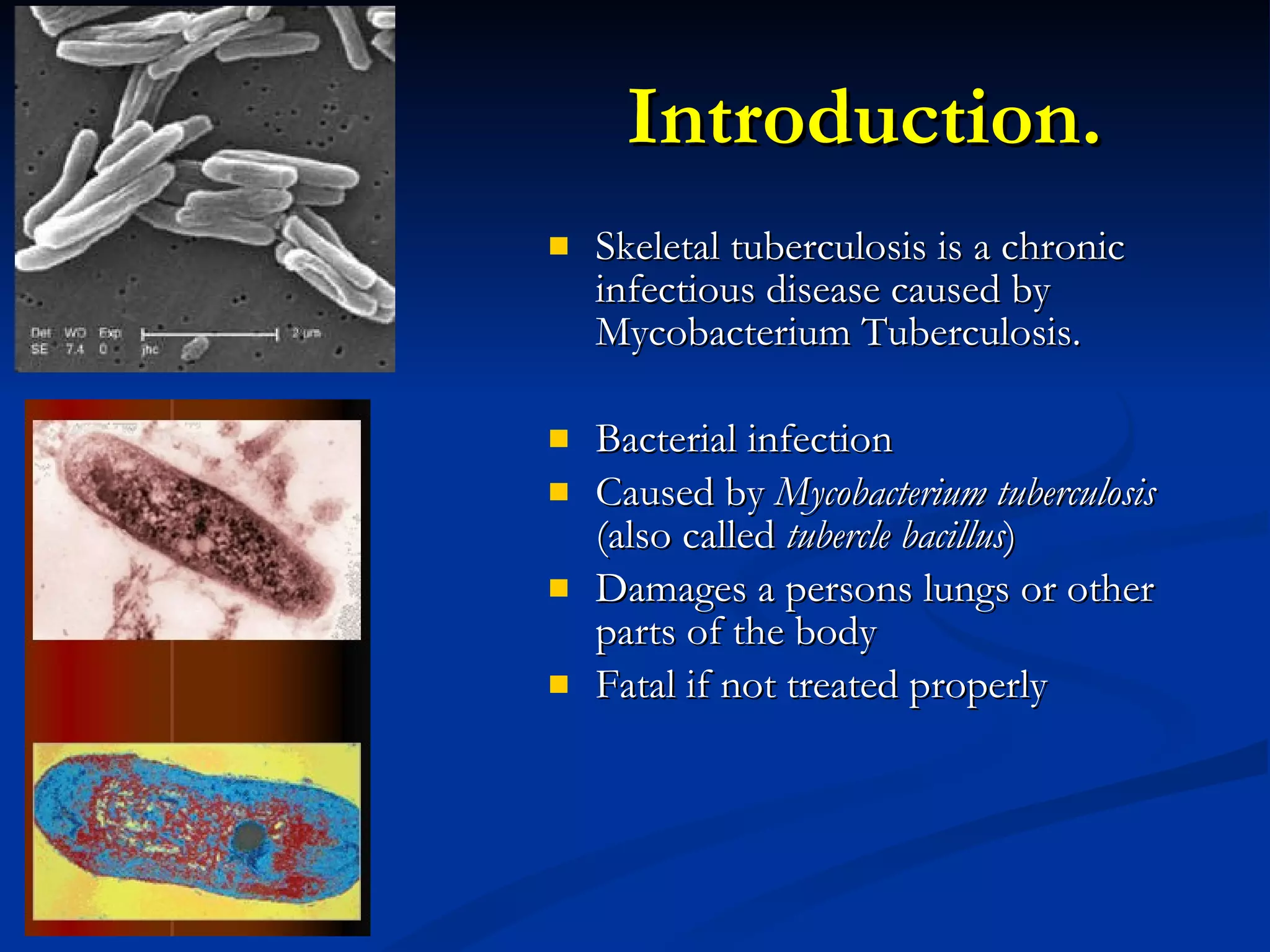Osteo articular tuberculosis -1 | PPT