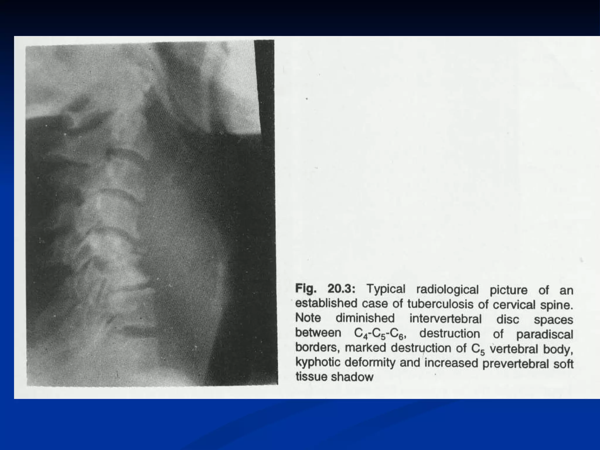 Osteo articular tuberculosis -1 | PPT