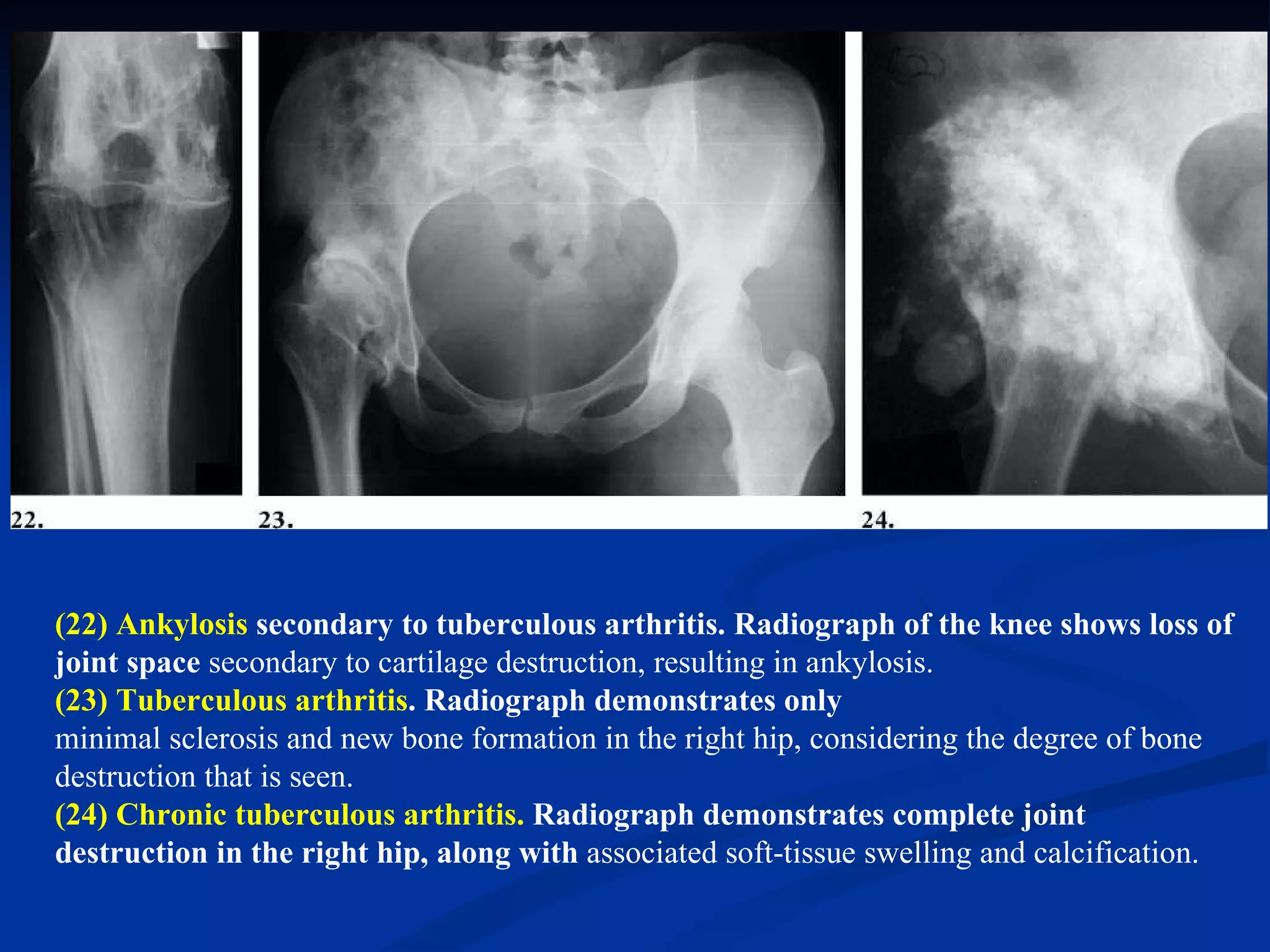 Osteo articular tuberculosis -1 | PPT