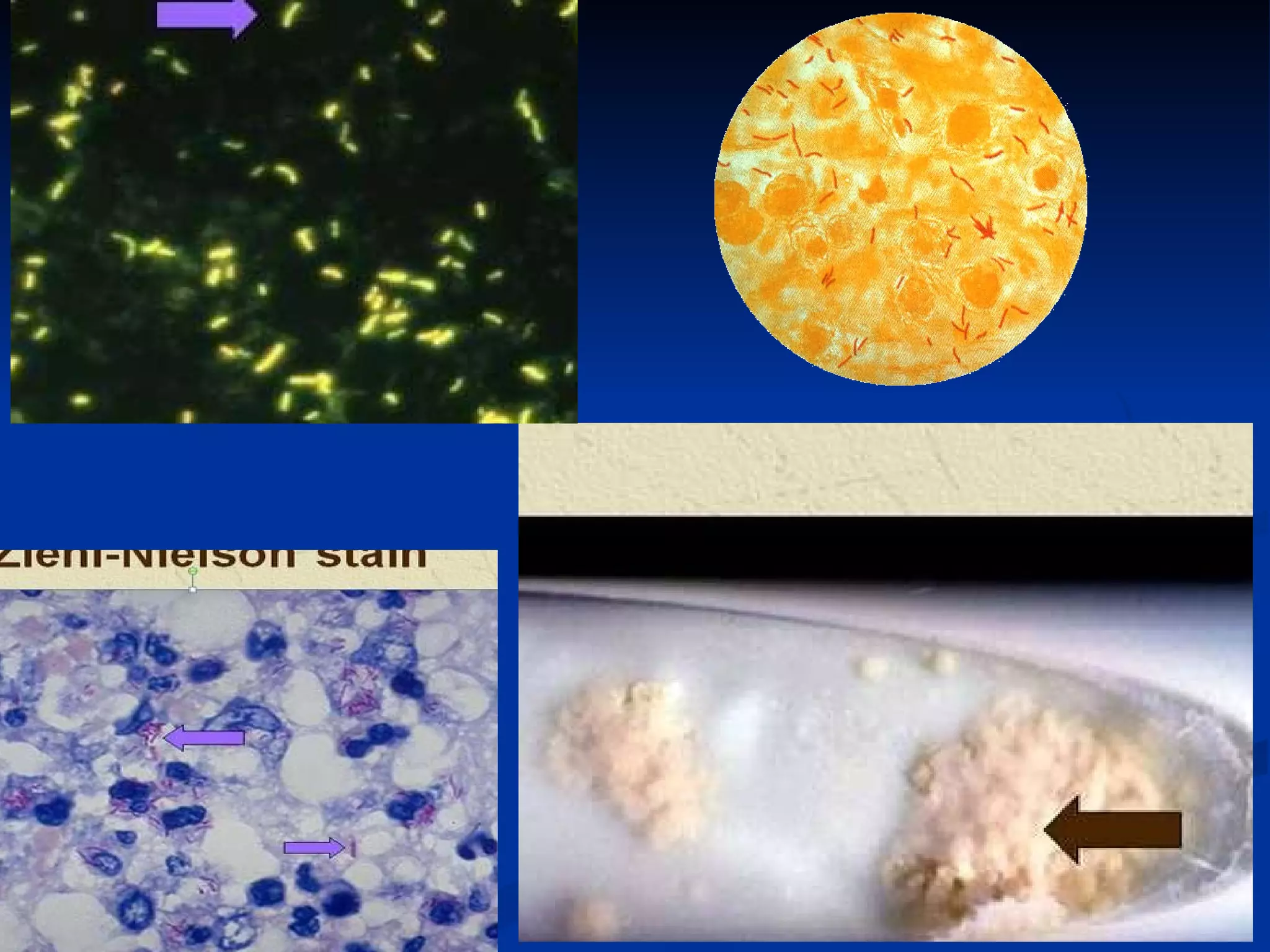 Osteo articular tuberculosis -1 | PPT